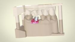 dental implant model 3d models | Page 1 | STLFinder