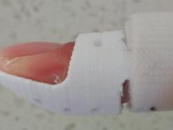 stack splint 3D Models | Page 1 | STLFinder