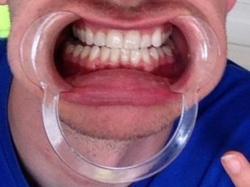 mouthguard challenge 3D Models | Page 1 | STLFinder