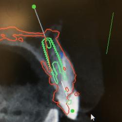 dental implant surgical guide 3D Models | Page 1 | STLFinder