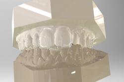 nti splints 3D Models | Page 1 | STLFinder