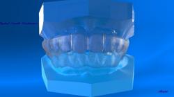 tooth positioner 3d models 【 STLFinder