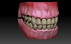 solidworks cad teeth and gums 3d models | Page 1 | STLFinder