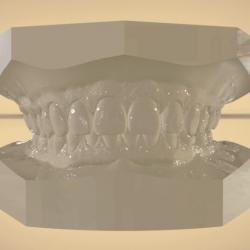 digital orthodontic models | Page 1 | STLFinder
