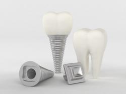 lakewood tooth implants 3D Models | Page 1 | STLFinder
