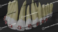 sims mb afm teeth high poly braces 3D Models | Page 1 | STLFinder