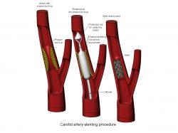 3d printed stent | Page 1 | STLFinder