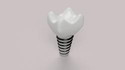 tooth implant with a halo 3D Models | Page 1 | STLFinder