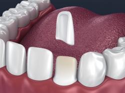 veneer preparation 3D Models | Page 1 | STLFinder